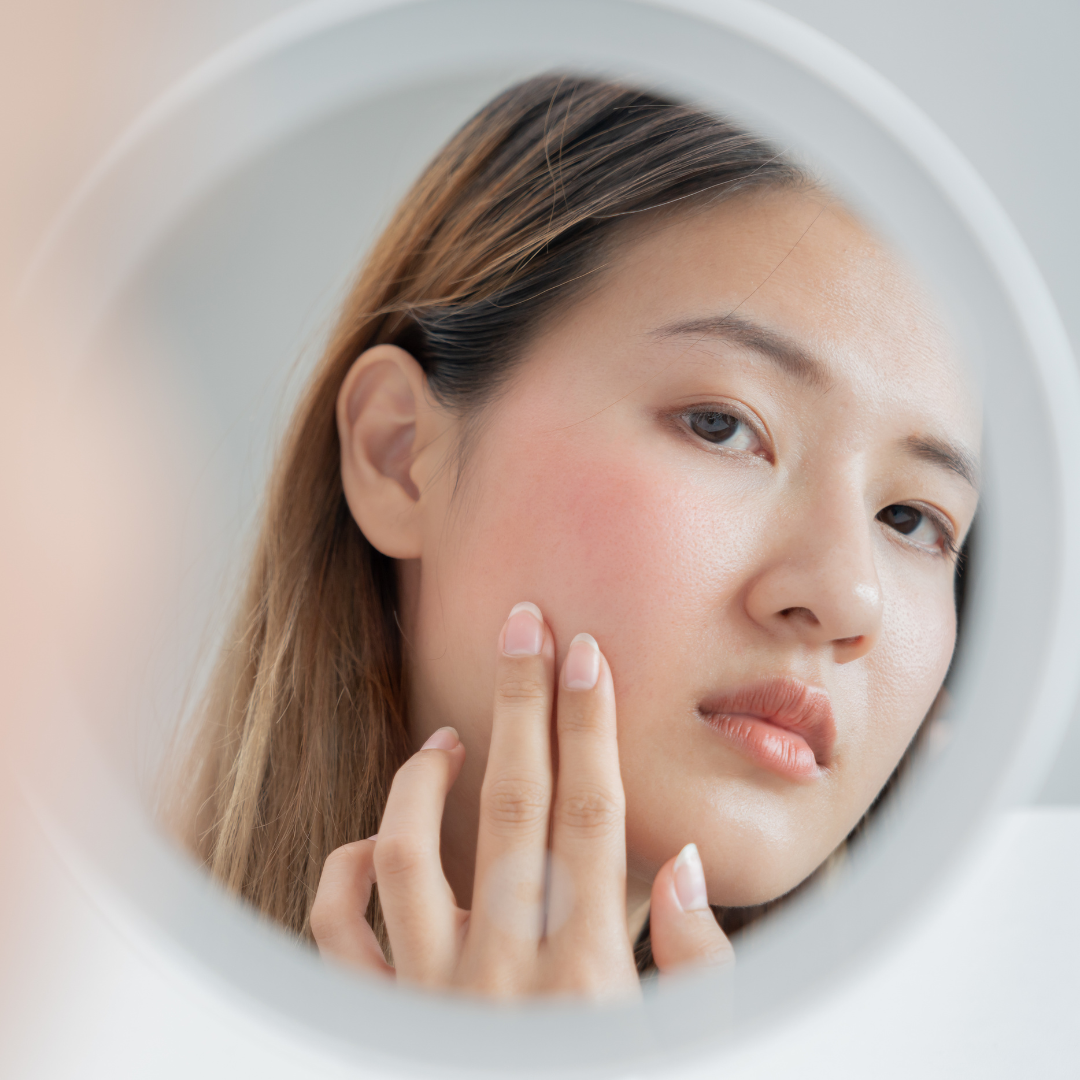 Natural Rosacea Redness Treatment: Your Guide – Blue Heron Botanicals